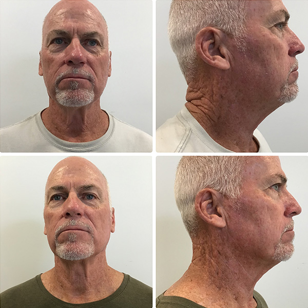 Before and After - Regenerate Wellness - Fort Lauderdale FL
